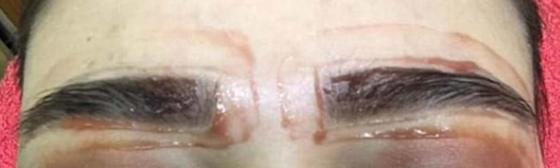 Australian woman left with STRIPEY eyebrows after botched microblading Australian woman left with STRIPEY eyebrows after botched microblading